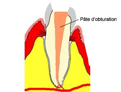 Dents dévitalisées - Dentiste Aix Les Bains - Dr BARBONI