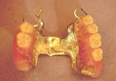 La prothèse amovible - Dentiste Aix Les Bains - Dr BARBONI